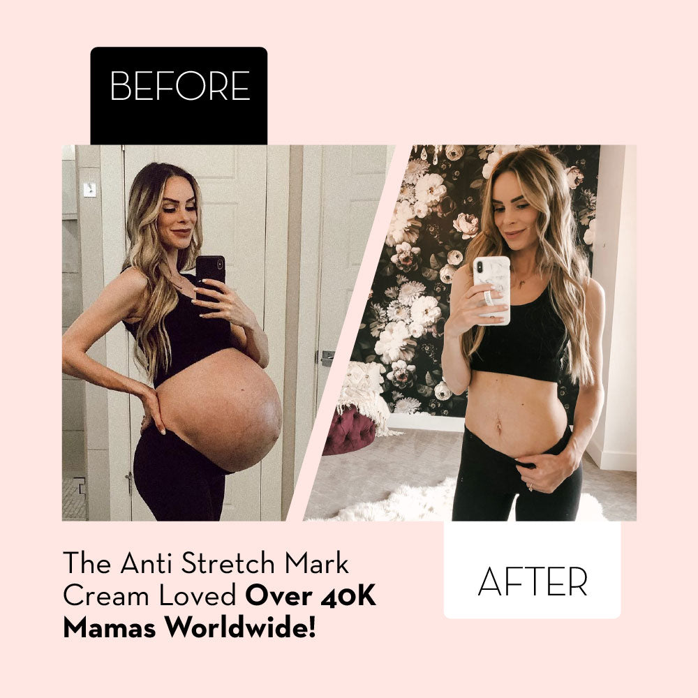 Stretch Marks During Pregnancy: Genetics, Causes & Skin Support